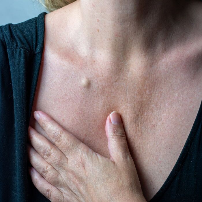 Lump and Cyst Treatments | Richard Evans Vascular