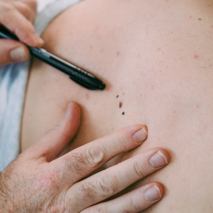 Safe and effective mole removal | Richard Evans Vascular